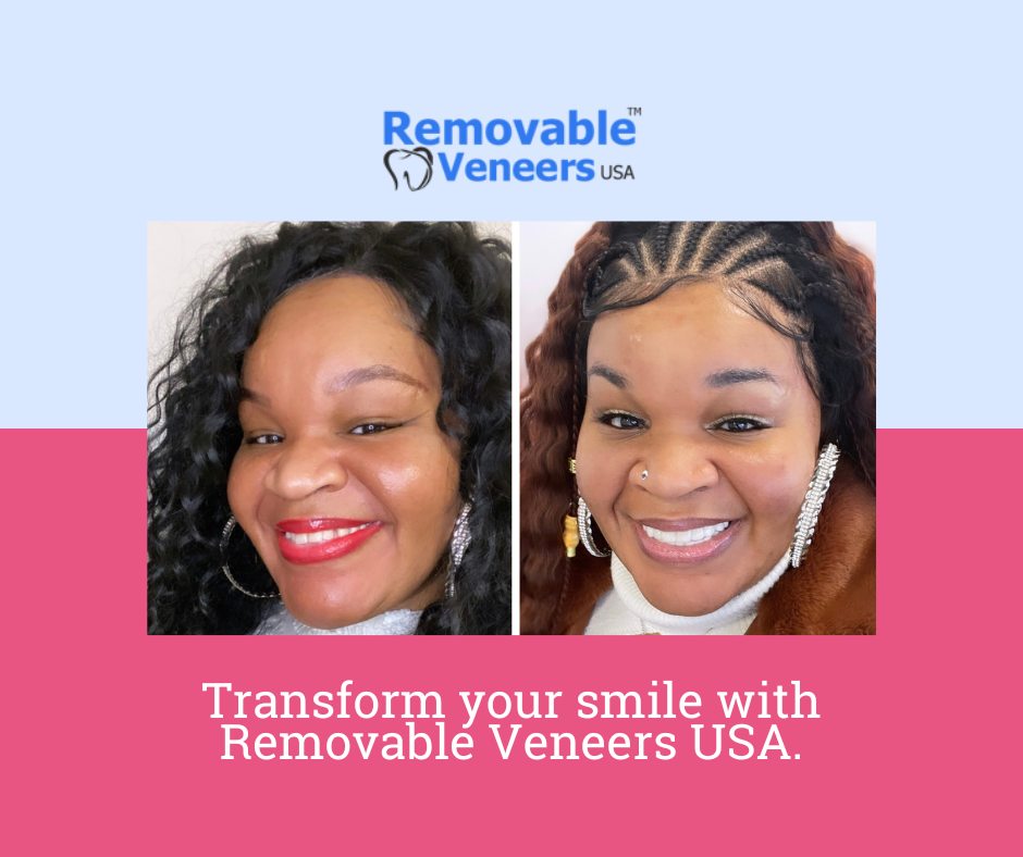 The Benefits of Choosing Clip-On Veneers for a Perfect Smile ...