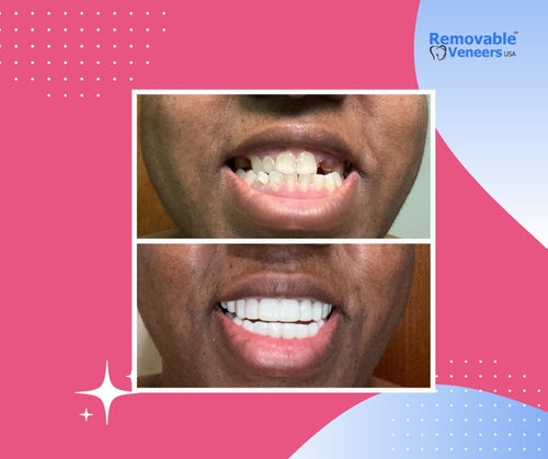 How to Care for Your Clip-On Veneers: A Complete Guide